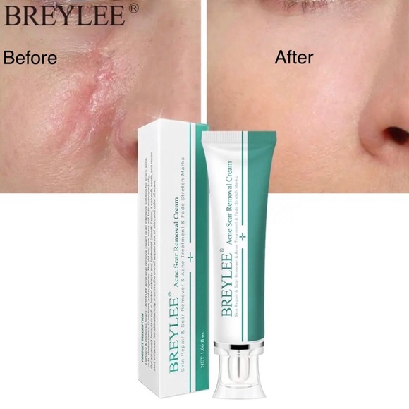 Sunubeautty | Skincare | Scar Removal Cream For Old And New Scars For ...